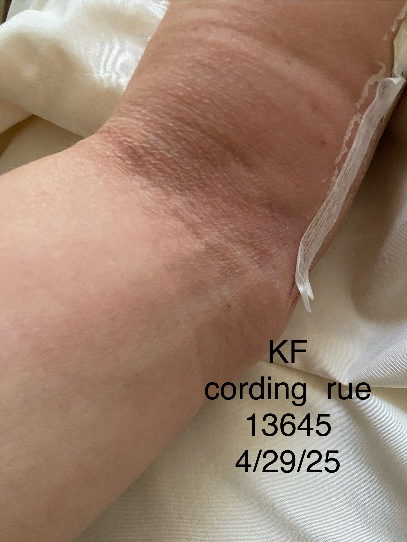 Navigating Cording with Lymphedema in Westbury, NY: A Clinical Yet ...