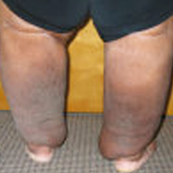 Lower Extremity Lymphedema And Edema Lower Extremity Lymphedema And Edema